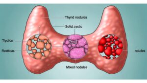 Nodules Thyroïdiens : Guide sur les Nodules et le Cancer de la Thyroïde